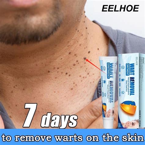Warts Remover Ointment Ubat Buang Kutil Ketuat Tahi Lalat Biji