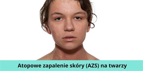 Atopowe Zapalenie Sk Ry Na Twarzy Poznaj Objawy I Leczenie