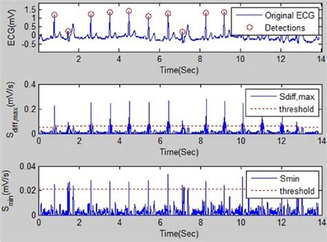 [pdf] a computationally efficient qrs detection algorithm for wearable ecg sensors semantic