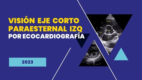 Vision EJE CORTO PARAESTERNAL IZQUIERDO por Ecocardiografía YouTube