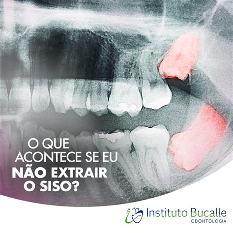 O que acontece se eu não tirar o siso Dentista em Curitiba PR