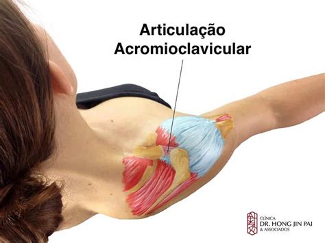 Artrose acromioclavicular artrose no ombro Clínica Dr Hong Jin Pai