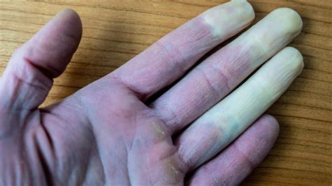 La Enfermedad De Raynaud Doctor Carlos Ochoa