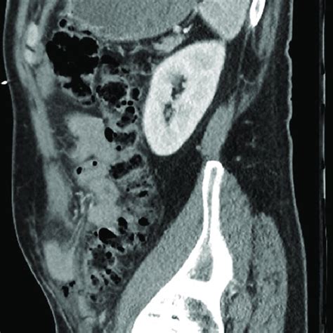 Spigelian Hernia Radiology