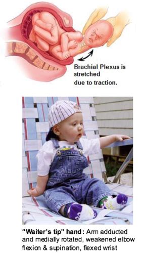 Anatomy Lec Brachial Plexus B Flashcards Quizlet
