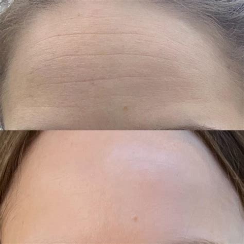 Best R Skincare Addiction Images On Pholder Before And After
