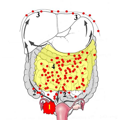 Prognosis Ovarian Cancer Spread To Peritoneum CancerWalls