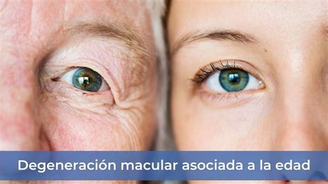 Degeneraci N Macular Asociada A La Edad