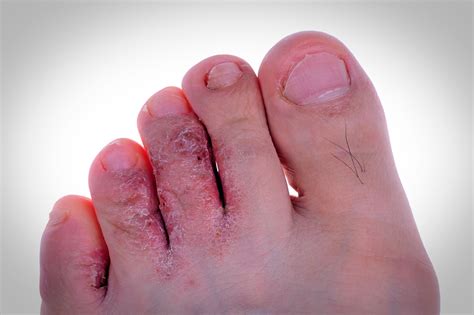 Hongos Pie Atleta Dermatomicosis Clínica del Pie Embajadores