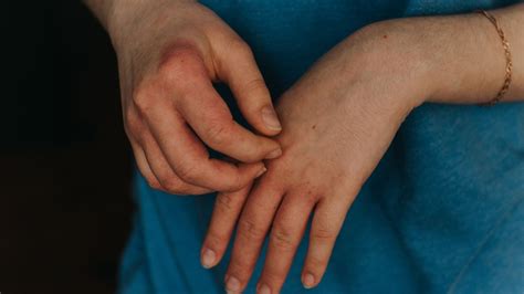 Alergia nas mãos quais as mais comuns Clínica Dra Juliana Toma