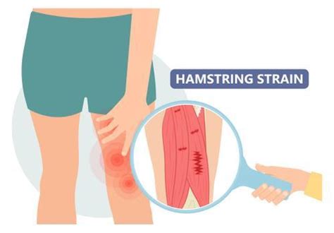 Hamstring Tear Symptoms Causes Treatment And More Elite Sports