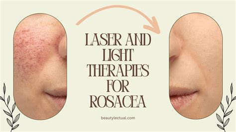 Rosacea Treatments Laser And Light Therapies Experience Intense Dye