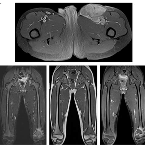 E Left Thigh Contrast Enhanced Magnetic Resonance MR A Axial
