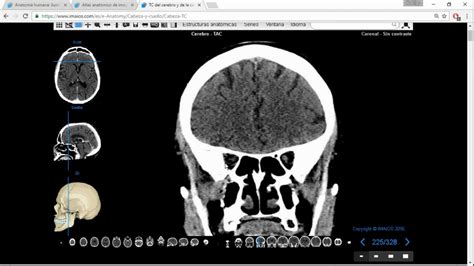 Tomografía Computada de Cabeza para Anatomía Parte 2 YouTube