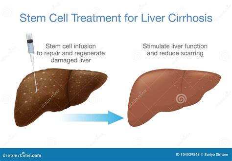Liver Cirrhosis Illustration Cartoondealer