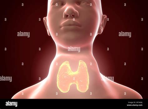 Toxic Diffuse Goiter Flajani Basedow Graves Disease D Illustration