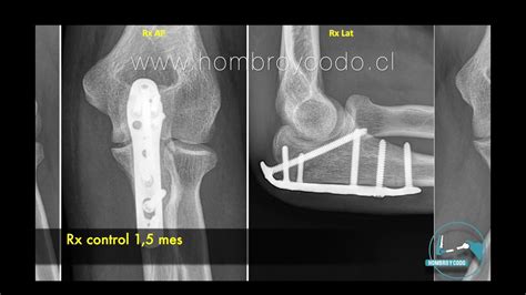 Cirugía codo Fractura olecranon fijación interna con placa y