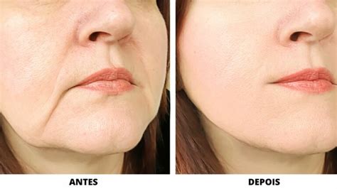 Bichectomia Clínica Hellen Gonçalves