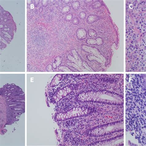 Colonoscopic Biopsy Findings Intestinal Mucosal Focal Heterotypic