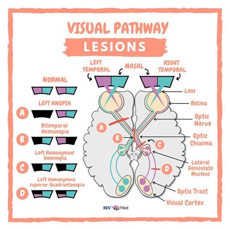 Lesions Along The Visual Pathway MEDizzy