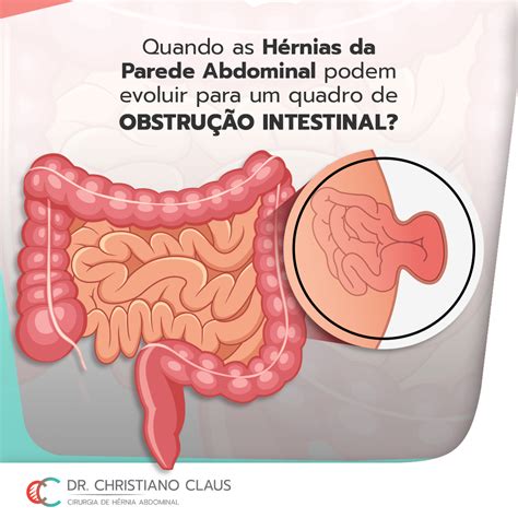 Quando as hérnias da parede abdominal podem evoluir para um quadro de