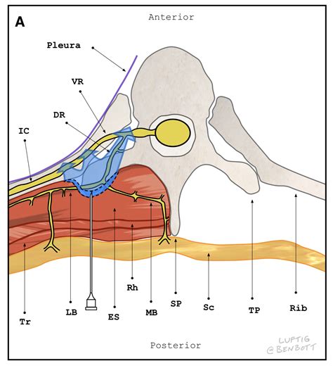 ERECTOR Highland EM Ultrasound Fueled Pain Management