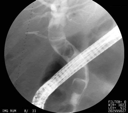 Ercp Stone Extraction