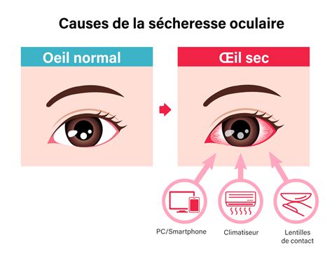 Ectropion causes symptômes traitements