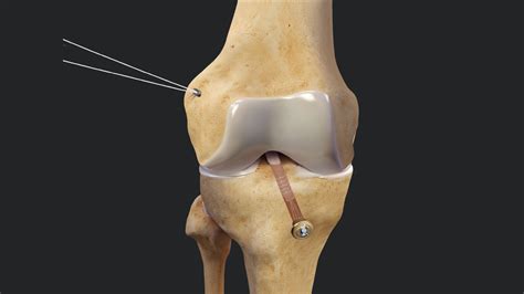 Arthrex Arthroscopic ACL Reconstruction With ACL Remnant Preservation