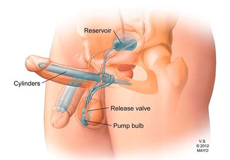 New Technique Prevents Reservoir Migration During Penile Prosthesis
