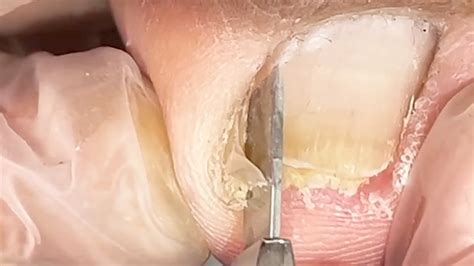 Daily Pedicure TutorialTake A Look At This Thick Ingrown Toenail Let