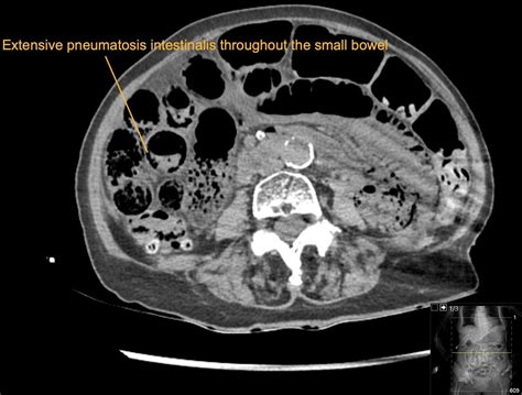 Ct Case Litfl Ct Scan Interpretation