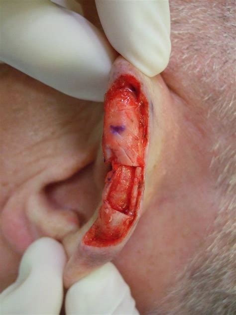 Basal Cell Cancer Of The Rim Of The Ear Dr Vindy Ghura Dermatologist