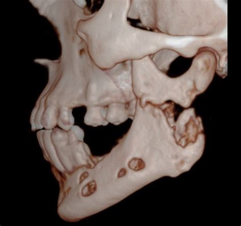 Computed Tomography Scan Of Facial Mass D Reconstruction Left