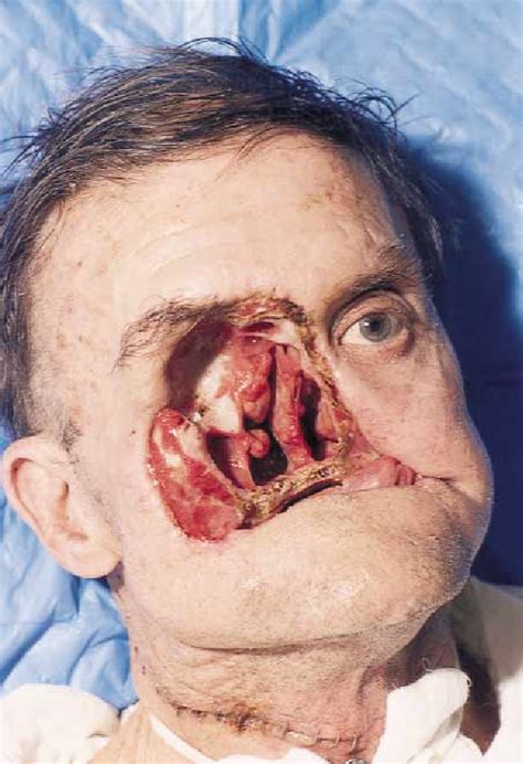Figure 1 From An Intraoral Extraoral Combination Prosthesis Using An