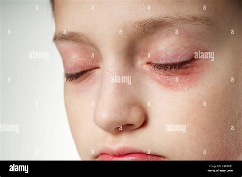 Allergic Reaction Skin Rash Close View Portrait Of A Girls Face Redness And Inflammation Of