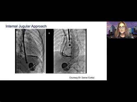 Leadless Pacemakers YouTube