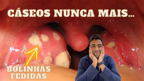 COMO ELIMINAR DEFINITIVAMENTE OS CASEOS DA AMÍGDALA SEM CIRURGIA