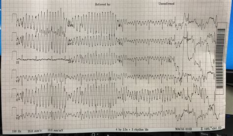 sinus rhythm with extensive artifact hint look at grepmed