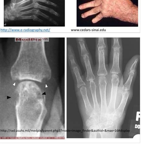 Rheumatology Flashcards Quizlet