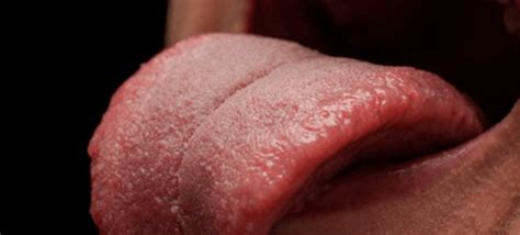 La salud de la lengua Clínica Dental Guadentis