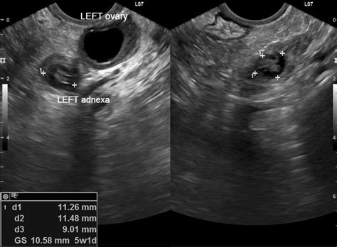 Signs And Symptoms Of Ectopic Pregnancy At 9 Weeks