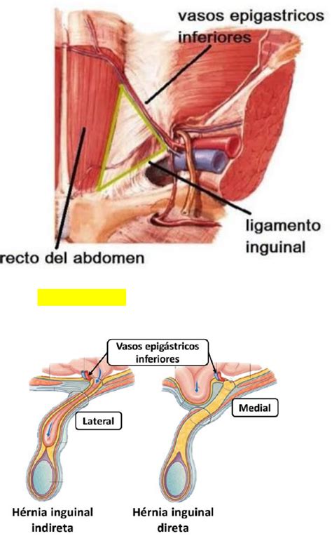 Oriental In Til Linha Do Site Hernia Inguinal Direta E Indireta Vasos