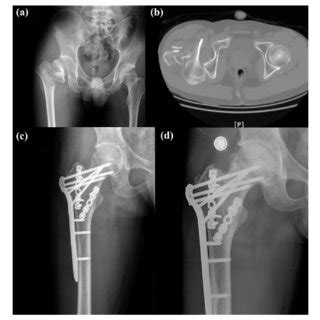 A Plain Preoperative Radiograph And B Three Dimensional