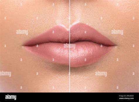 Comparison Of Female Lips Before And After Augmentation Stock Photo Alamy