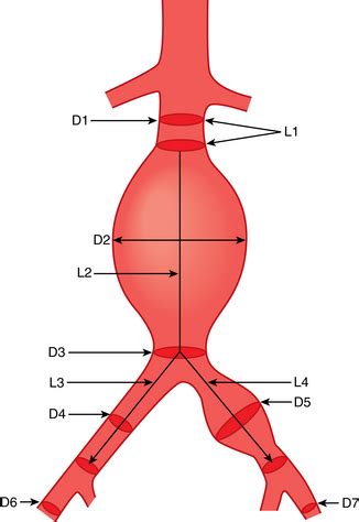 Aorta Diameter Radiology