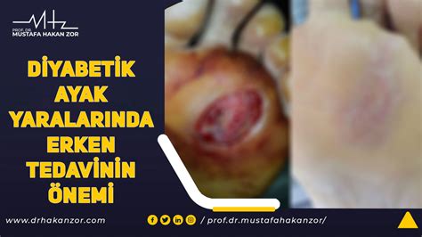 Diyabetik Ayak Yaralarında Erken Tedavinin Önemi Diyabetik Ayak Nedir