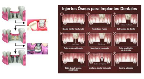 Evitar retracción de encía y pérdida de hueso tras extracción dental