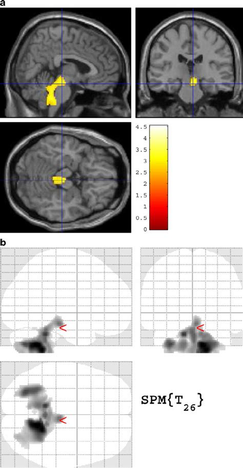 Statistical Parametric Mapping Spm Showing The Negative Correlation