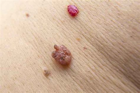 Cherry Angiomas How Best To Remove These Fast Effectively